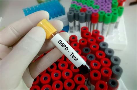 Francesco Damico On Linkedin Deficit Di Glucosio 6 Fosfato Deidrogenasi