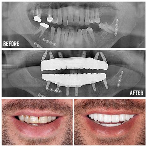 All On 6 Antalya Dentarma Dental Clinic Turkey Dental Implant