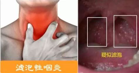 嗓子干痒疼痛如何摆脱慢性咽炎方回春堂非遗技艺有膏招 凤凰网