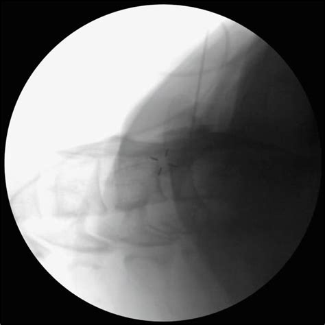 Stellate Ganglion Block Anesthesia Key