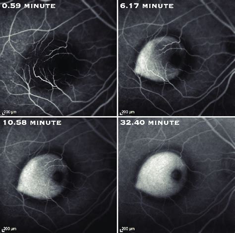 Fluorescein Angiography Of The Right Eye Shows Pooling Download Scientific Diagram