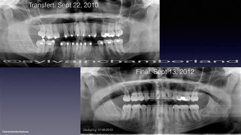Ethnicity And Premolar Extraction Dr Sylvain Chamberland Orthodontist