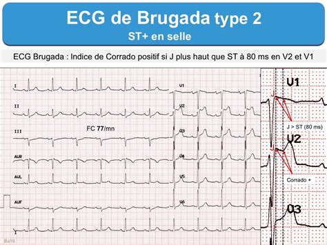 Syndrome De Brugada 2 Dg Ecg E Cardiogram