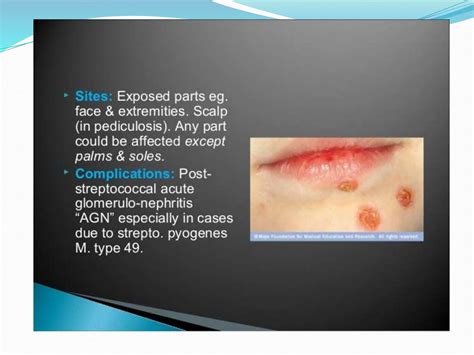 Cellulitis Superficial Bacterial Infection Pptx