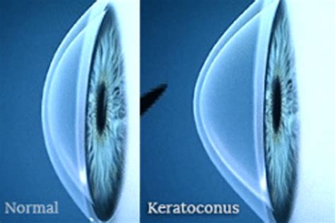 Is Lasik The Right Treatment For Keratoconus