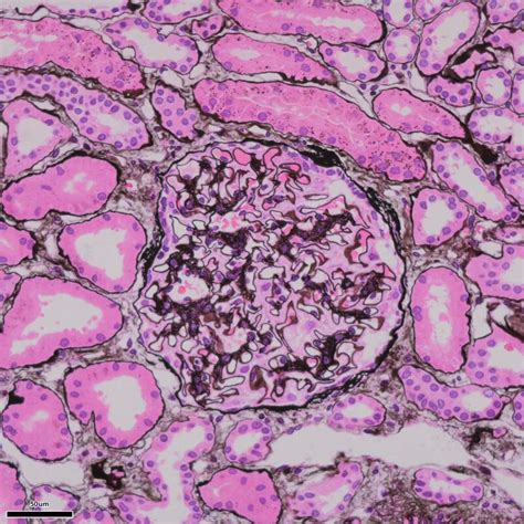 Membranous Nephropathy Pam Staining 40x Galleries Nikon Europe Bv