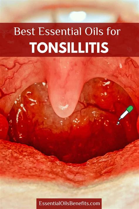 Best Essential Oils For Tonsillitis Artofit