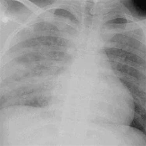 Supine Chest X Ray Revealed Disseminated Areas Of Hazy Increased Lung Download Scientific