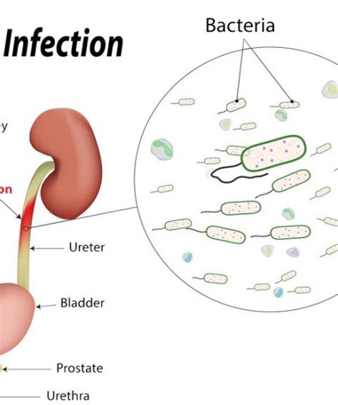 What Antibiotic For A Bladder Infection