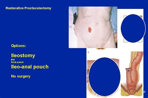 Restorative Proctocolectomy Kangaroo Club Information Day Bruce George