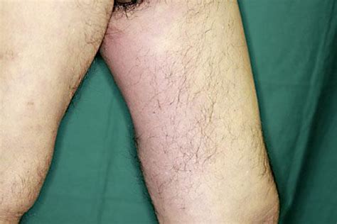 Clinical Appearance Of Cellulitis On The Right Thigh Download