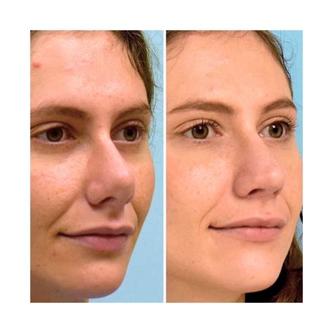 Rhinoplasty Nose In London Ontario London Plastic Surgery London