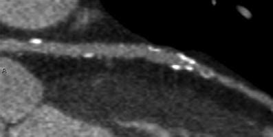 Evaluation Of The Myocardial Supply Fast KV Switching Dual Energy CT Radiology Key