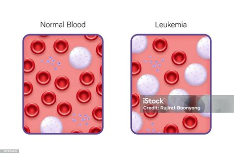 백혈병 벡터 정상 혈액과 백혈병의 차이 적혈구 백혈구 및 혈소판 건강 진단에 대한 스톡 벡터 아트 및 기타 이미지 건강 진단