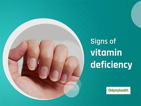 Vitamin D Deficiency Symptoms Faqs