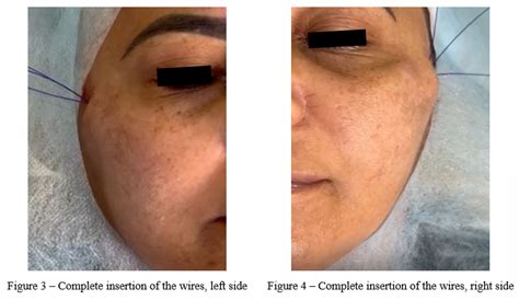 Efficacy Of Polydioxanone Threads For The Treatment Of Facial Sagging