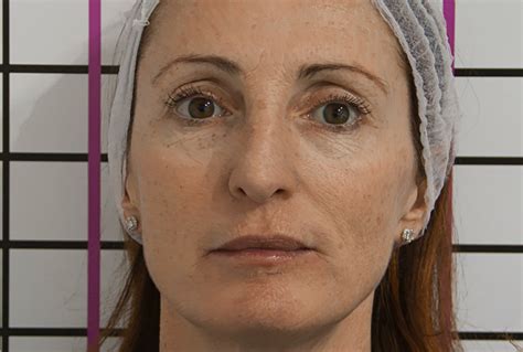 Laser Clinic Paris | PQ Age пилинг