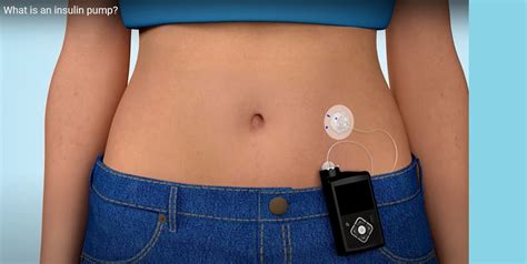 Insulin Lispro Sliding Scale