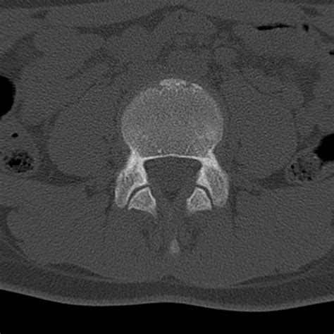 Bilateral Pars Defect Radiopaedia 26691 26846 Axial Bone Window Nc Commons