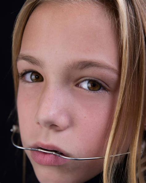 100 Girls With Braces Ideas Braces Braces Girls Brace Face
