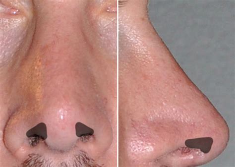 Soft Tissue Triangle Of Nose Dr Barry Eppley Indianapolis Explore Plastic Surgery