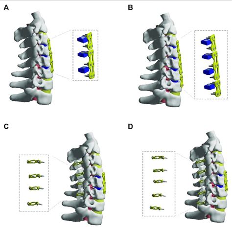 The Fe Models Of C4 C6 Acdf And One Level Or Two Level Asd After Download Scientific Diagram