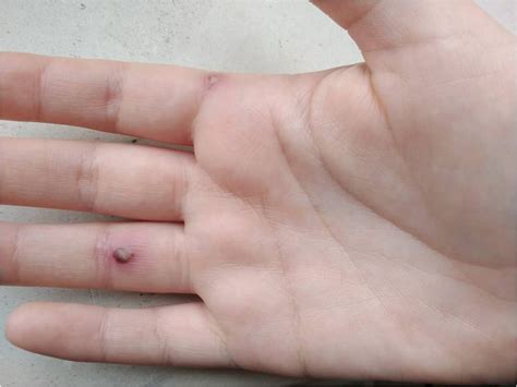 Disseminated Gonococcal Infection