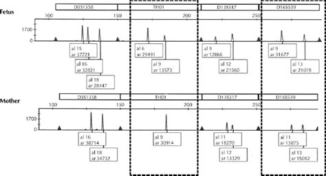 Microsatellite Genotyping Result For A Case Of Partial Hydatidiform Download Scientific Diagram