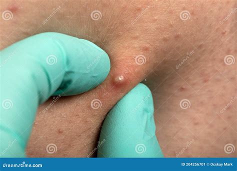 Folliculitis Genital