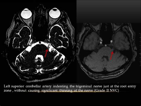 Imaging In Neurovascular Conflict Of The Trigeminal Nerve With Grading Of Its Severity