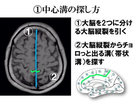 脳画像から一次体性感覚野3 1 2野を探す方法とは リハアイデア