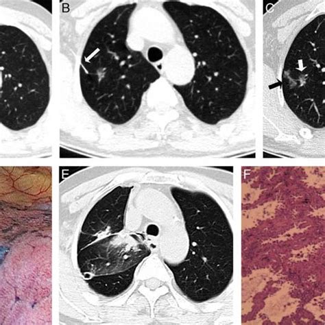 Illustration Of Preparing Methylene Blue Stained Glue For Ct Guided Download Scientific Diagram