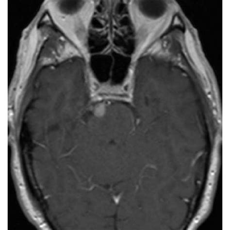 Concordant Visibility Of The Trochlear Nerves On Conventional And Download Scientific Diagram