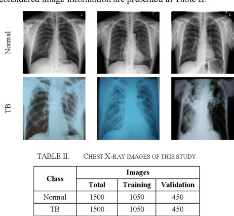 Table Ii From Tuberculosis Detection From Chest Radiographs With Pre Trained Deep Learning