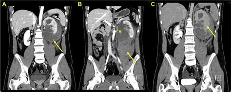 Abdominal Computed Tomography Ct Scan Showing Active Extravasation Of Download Scientific