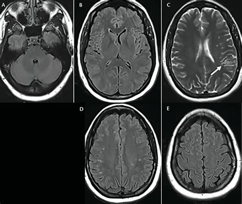 A Practical Guide To Diagnosing And Undiagnosing Multiple Sclerosis The Neurology Hub