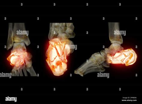 Ct Scan Ankle Joint With 3d Rendering Of Calcaneus Bone Showing Calcaneus Heel Bone Fractures