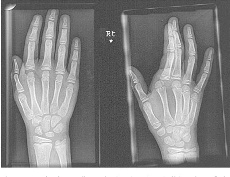 Figure 1 From Kaplans Puckering Sign In Complex Dorsal Dislocation Of The Metacarpophalangeal