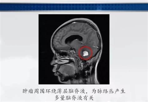 四脑室肿瘤影像诊断与鉴别诊断 医学界 助力医生临床决策和职业成长