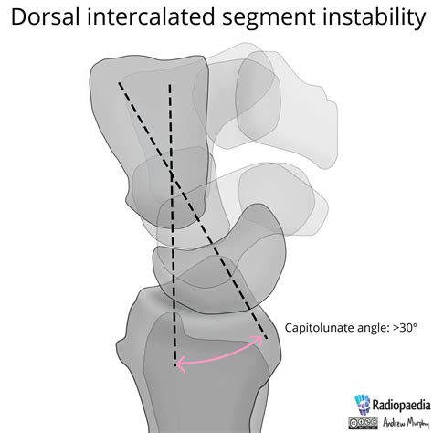 Filenormal Wrist Alignment Dorsal And Volar Intercalated Segmental Instability Illustration