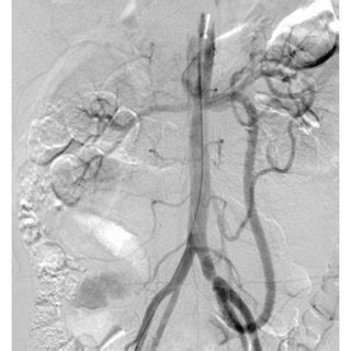 Postoperative Month Control DSA Imaging Download Scientific Diagram