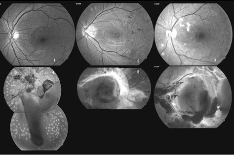 糖尿病视网膜病变 临床眼科学图谱 医学