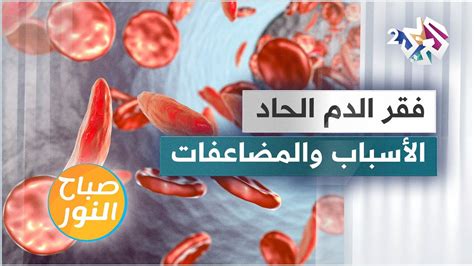فقر الدم الحاد الأسباب والمضاعفات وطرق العلاج Youtube