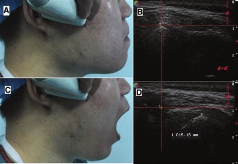 The Temporomandibular Joint Mobility Sonographic Methods And Condylar