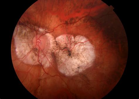 deep learning models can identify myopic maculopathy ophthalmology advisor