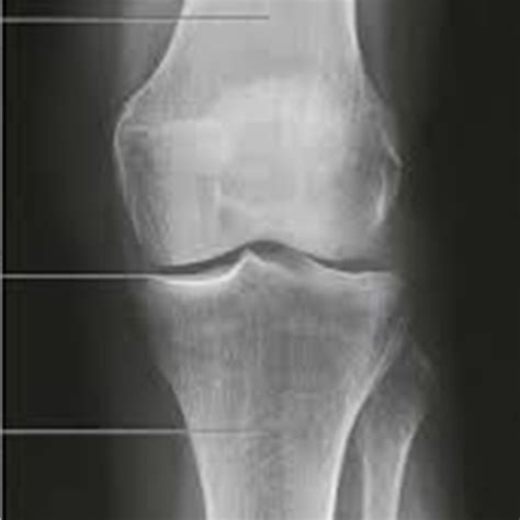 X Ray Left Patella Lat And Axial Test Price In Delhi Ganesh Diagnostic