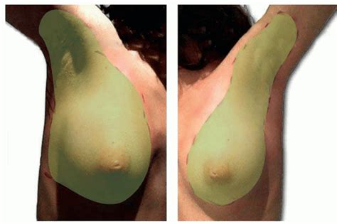 Ultrasound Guided Pectoral Plane Nerve Block—pecs Ii Anesthesia Key