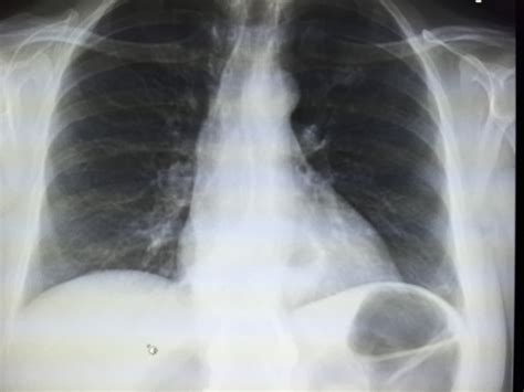 Subsegmetal Atelectasis On Chest X Ray Radiology In Plain English Subsegmetal Atelectasis On Chest X Ray Radiology In Plain English