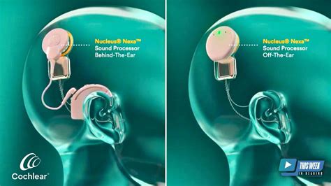 Inside The Cochlear Nucleus Nexa Implant System Advancing Hearing Outcomes Through Innovation