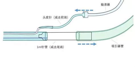 画说引流管教你轻松搞定腹腔冲洗第二节 安骏医疗